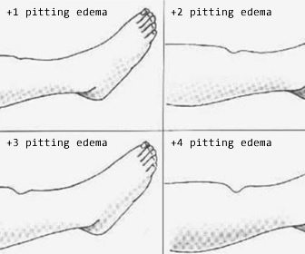 Pitting Edema Scale: Grading & Assessment for Nurses
